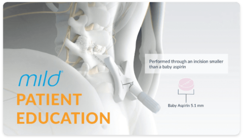 Minimally Invasive Lumbar Decompression (MILD) Procedure – Knee and ...