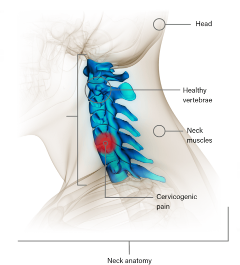 Migraine & Cervicogenic Headaches | Pain Treatment Specialists