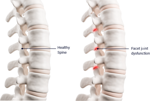 What is facet joint dysfunction? Find out how to treat it!