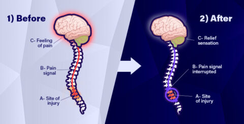 Leg pain neurostimulation